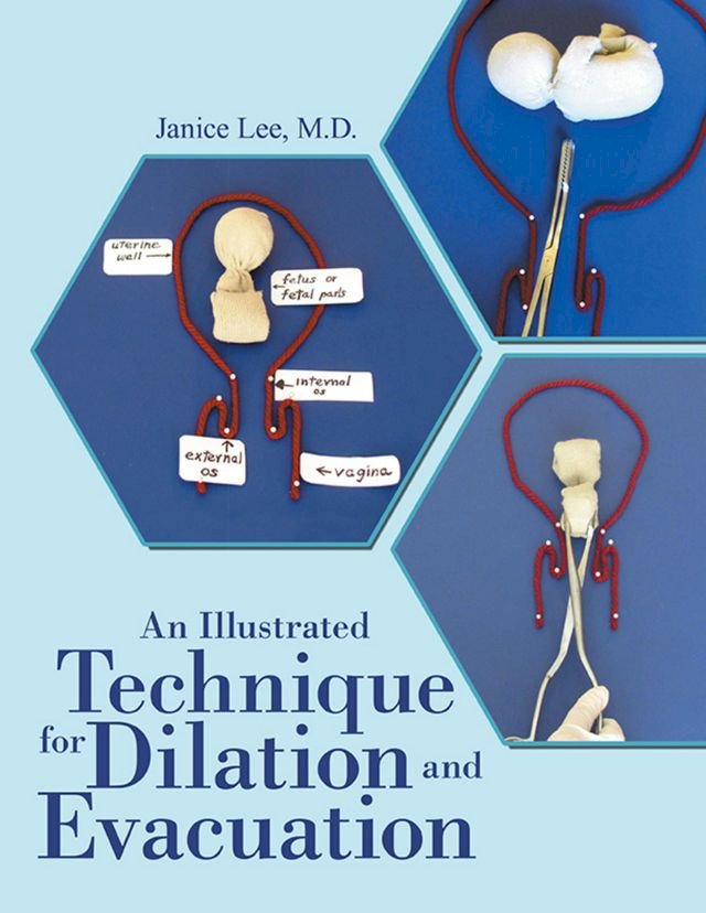 An Illustrated Technique for Dilation and Evacuation - PChome 24h書店